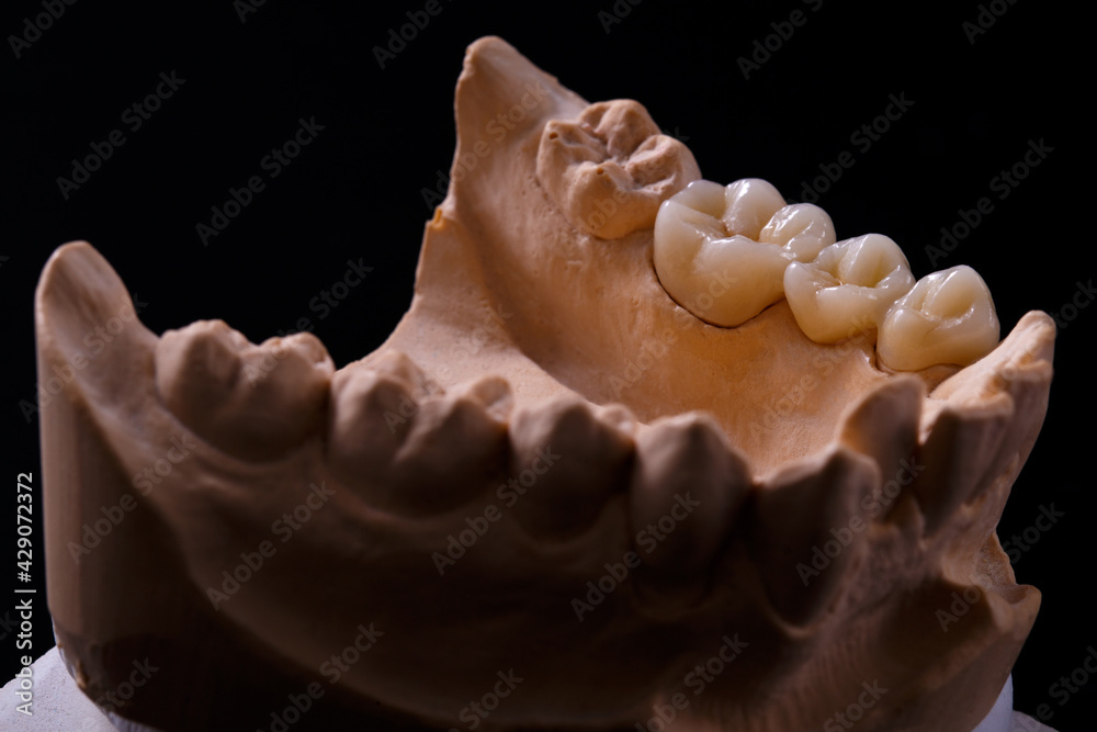 Mold of teeth. Gypsum model plaster of teeth. Stomatologic plaster cast ...