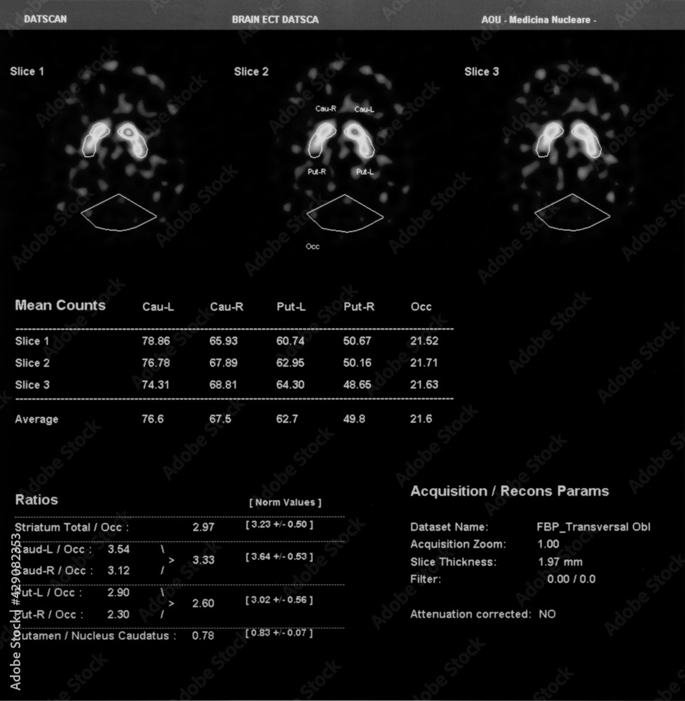 Brain DATSCAN of neurological patient. Nuclear medical examination that ...