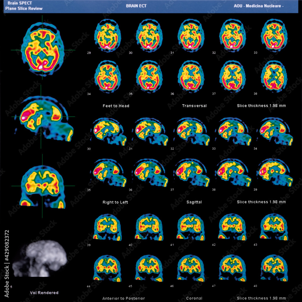 Brain SPECT of neurological patient. Color image of nuclear medical ...
