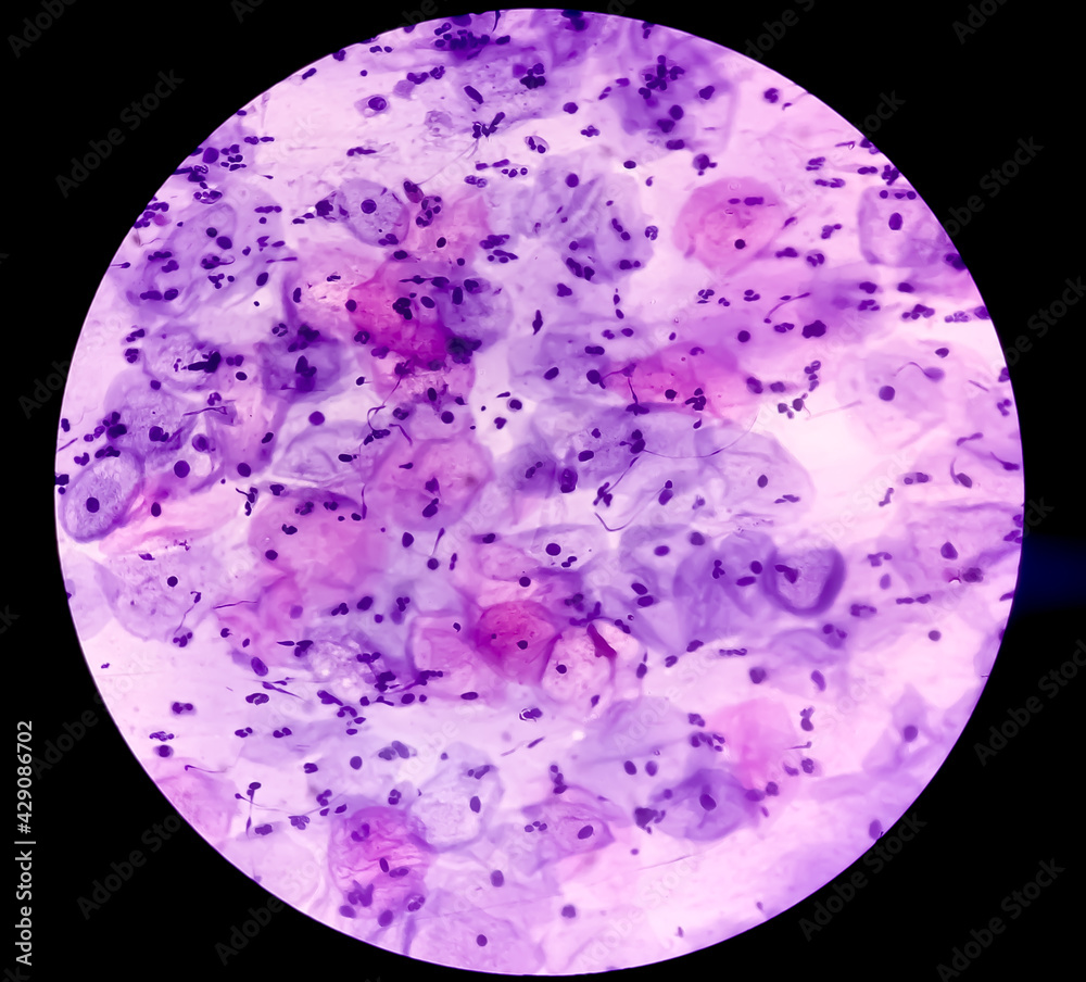 Microscopic view of human cervix cells. Squamous epithelial cells. Pap ...