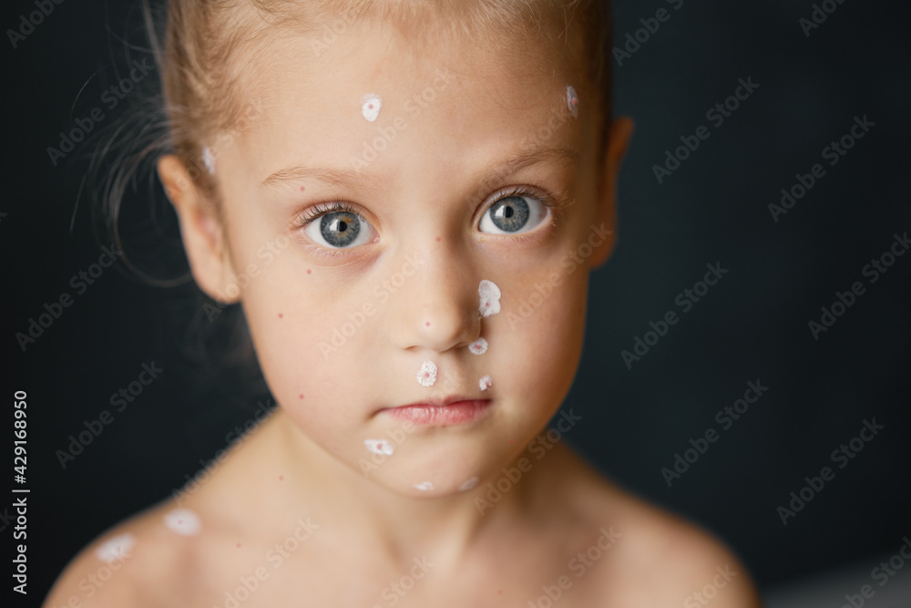 Portrait of smilling little child girl with chickenpox. Sick toddler ...