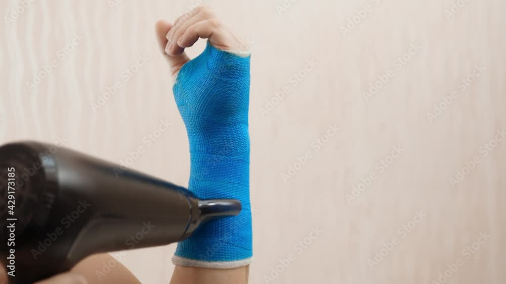 Broken wrist in fiberglass plaster cast. Male hand wrapped in a modern ...