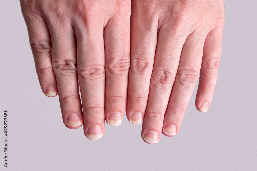 Onychomycosis or fungal nail infection on damaged nails after gel ...