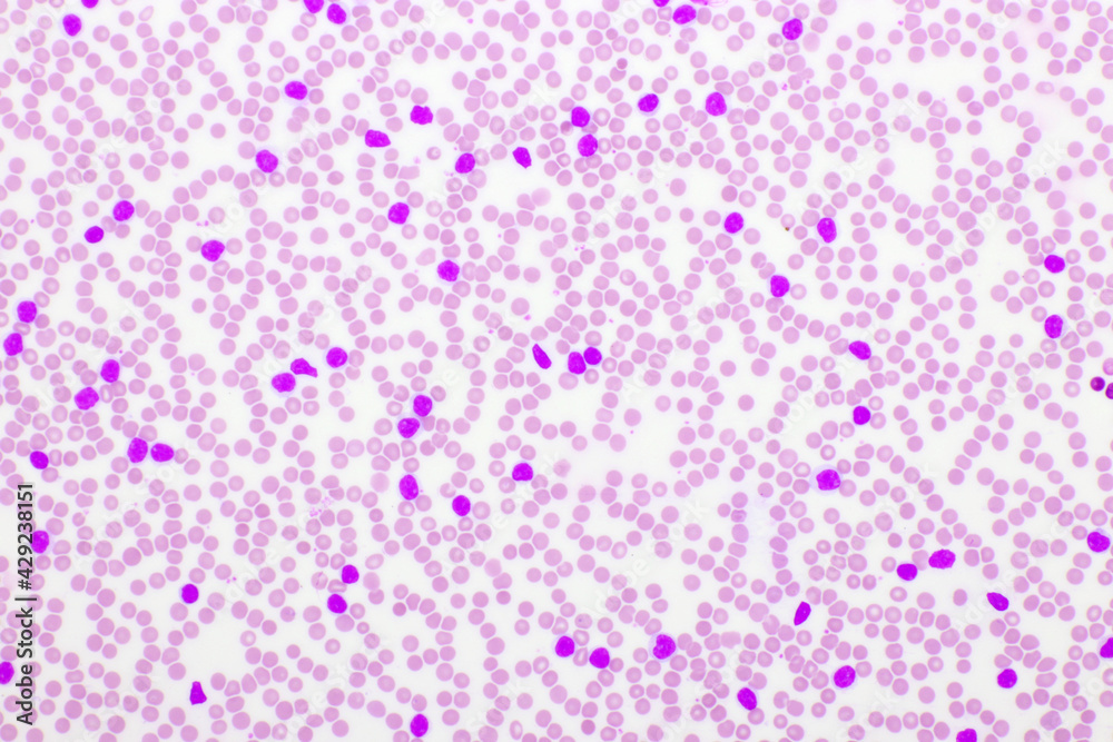 Picture of acute lymphocytic leukemia or ALL cells in blood smear ...