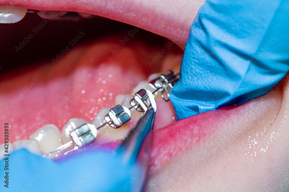 Installation of a metal arch on braces, orthodontics, treatment and ...