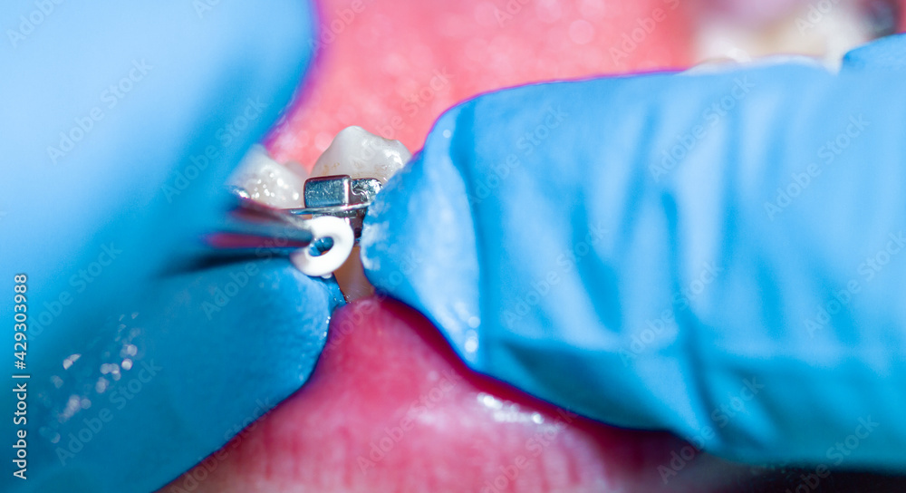 Installation of a metal arch on braces, orthodontics, treatment and ...