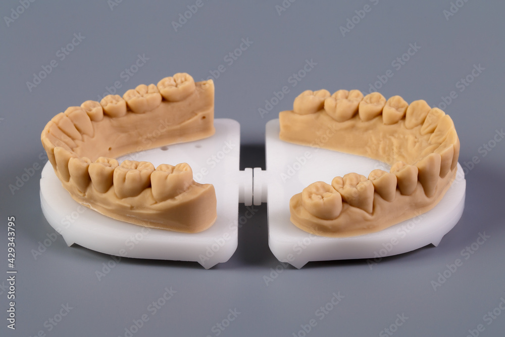 Mold of teeth. Gypsum model plaster of teeth. Plaster cast of teeth ...