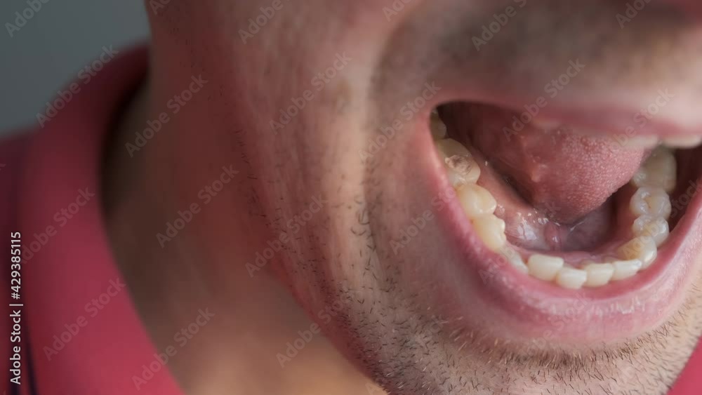 Vidéo Stock A tooth in a man's mouth with a temporary filling seal ...