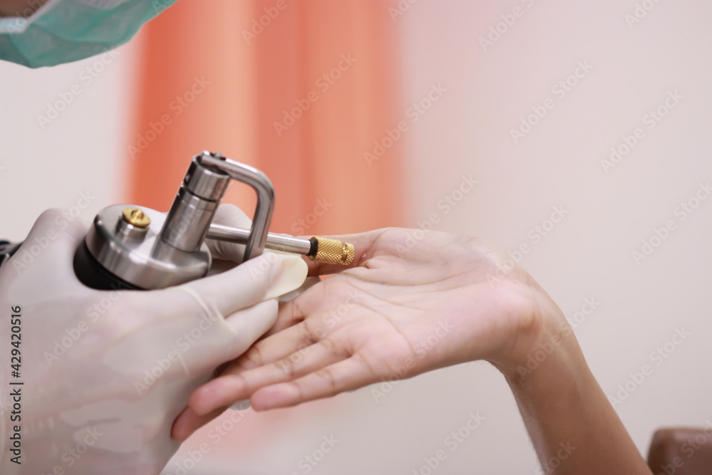 A close-up image of a dermatologist using a liquid nitrogen spray to ...