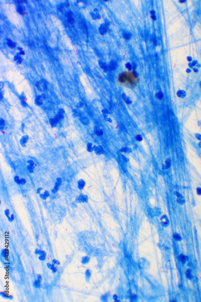 Mycobacterium tuberculosis positive (small red rod) in sputum smear ...