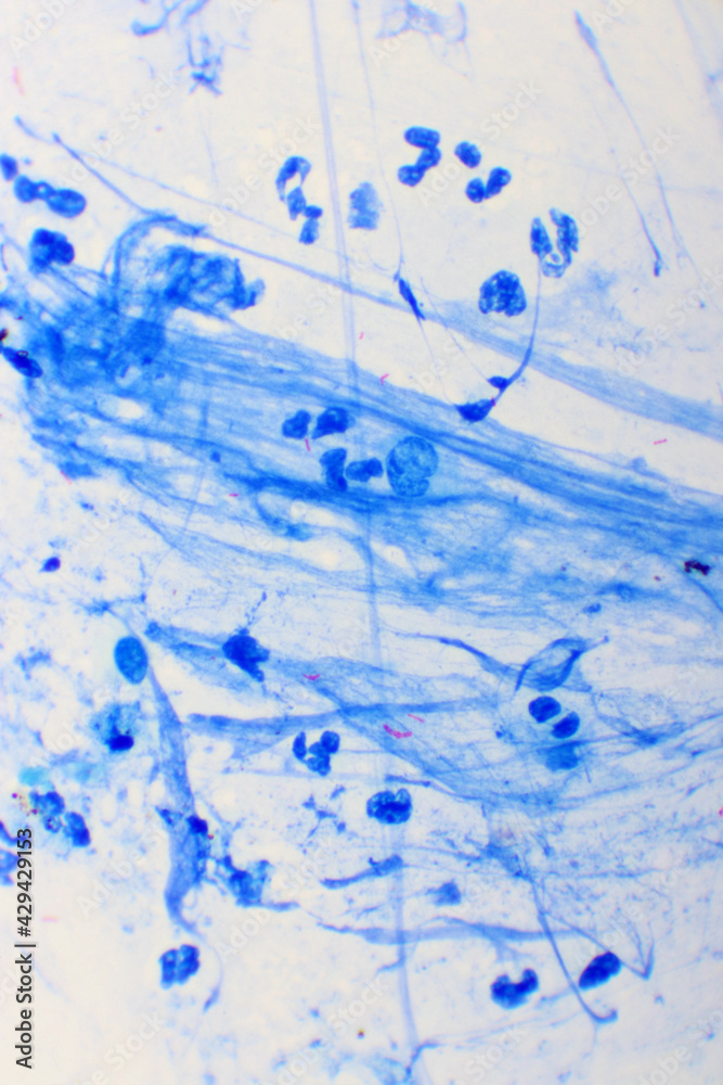 Fototapeta mapa świata dla dzieci Mycobacterium tuberculosis positive ...