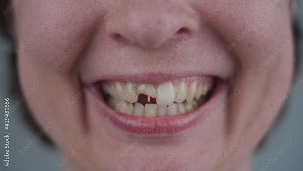 Topic restoration teeth after chips, trauma and damage. Close-up ...