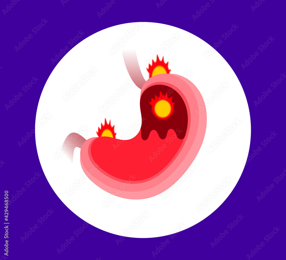 Acid reflux heartburn acidity in stomach vector isolated flat icon acid ...