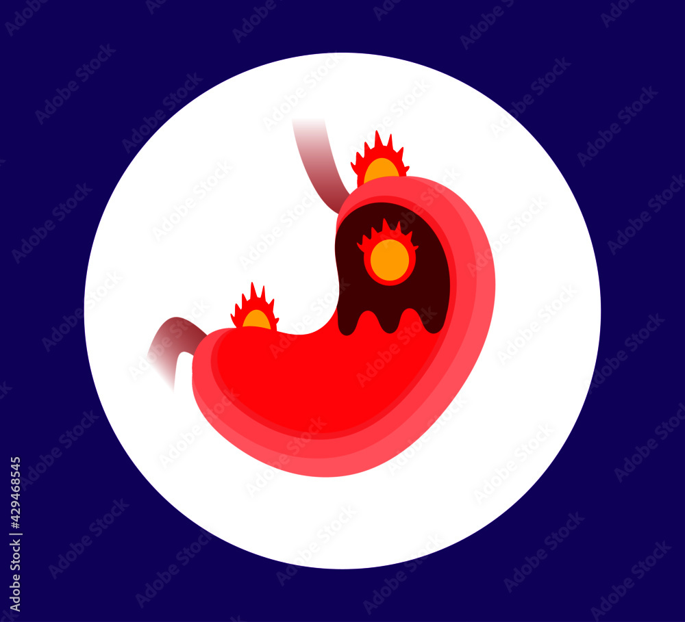 Acid reflux heartburn acidity in stomach vector isolated flat icon acid ...