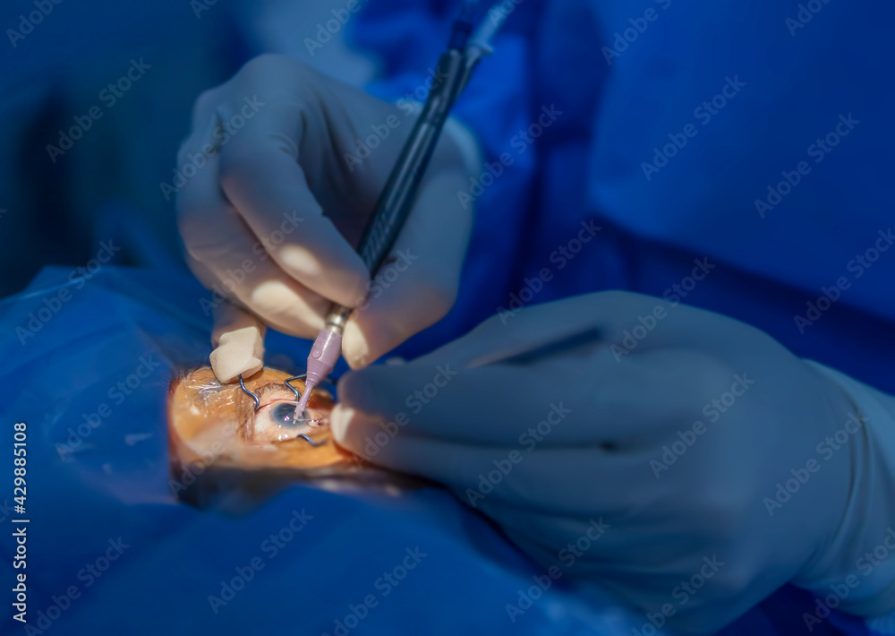 Eye surgery. A patient and surgeon in the operating room during ...