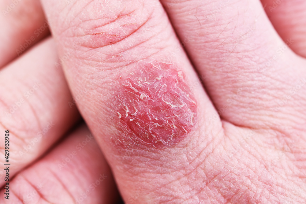 Atopic dermatitis (AD), also known as atopic eczema, is a type of ...
