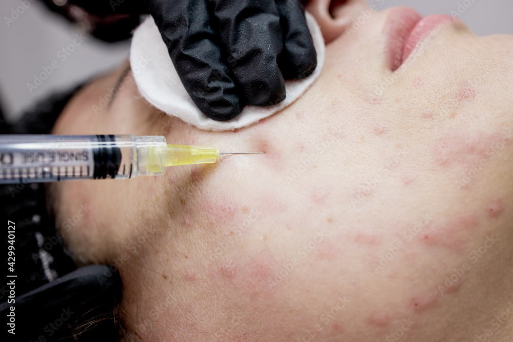 Cosmetologist doctor is making multiple injections biorevitalization ...