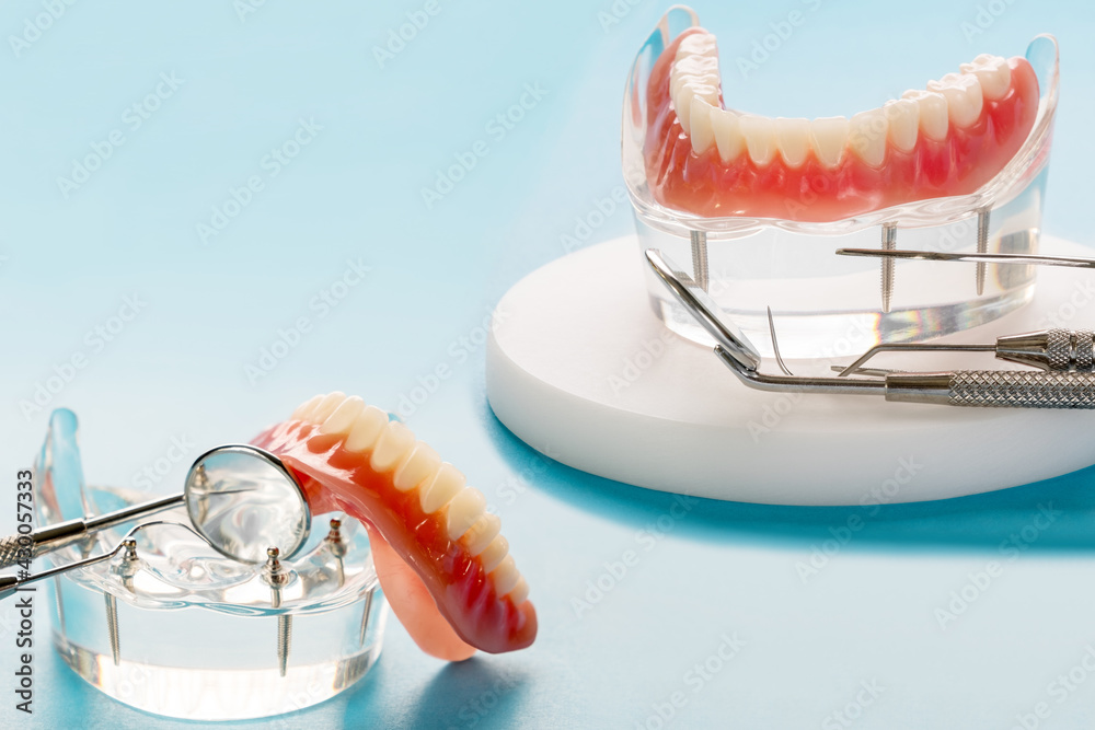 Teeth model showing an implant crown bridge model/ dental demonstration ...