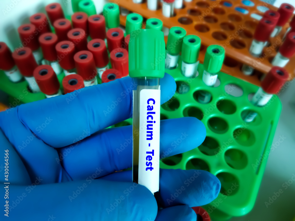 Blood sample tube for Calcium test at medical laboratory Stock Photo ...