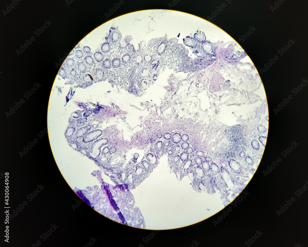 Colon Cancer: Photomicrograph (microscopic image) of colonic ...