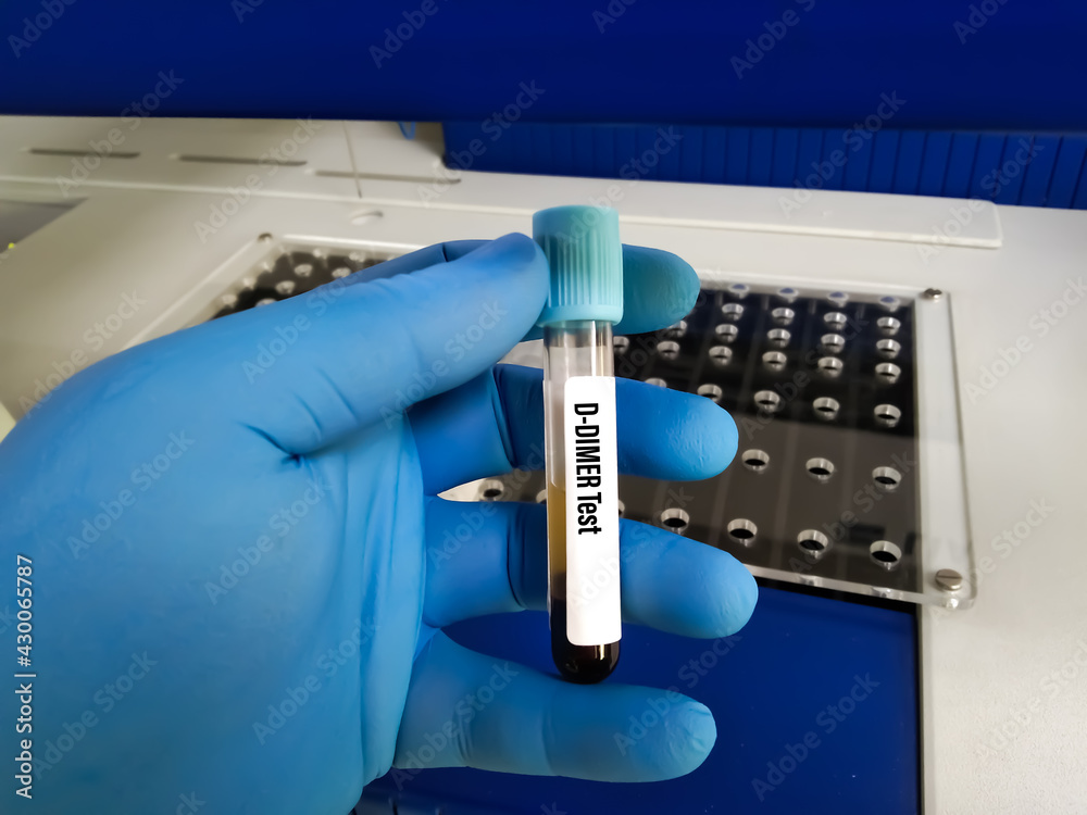 D-Dimer test. Corona patient monitoring test in ICU. Doctor or ...