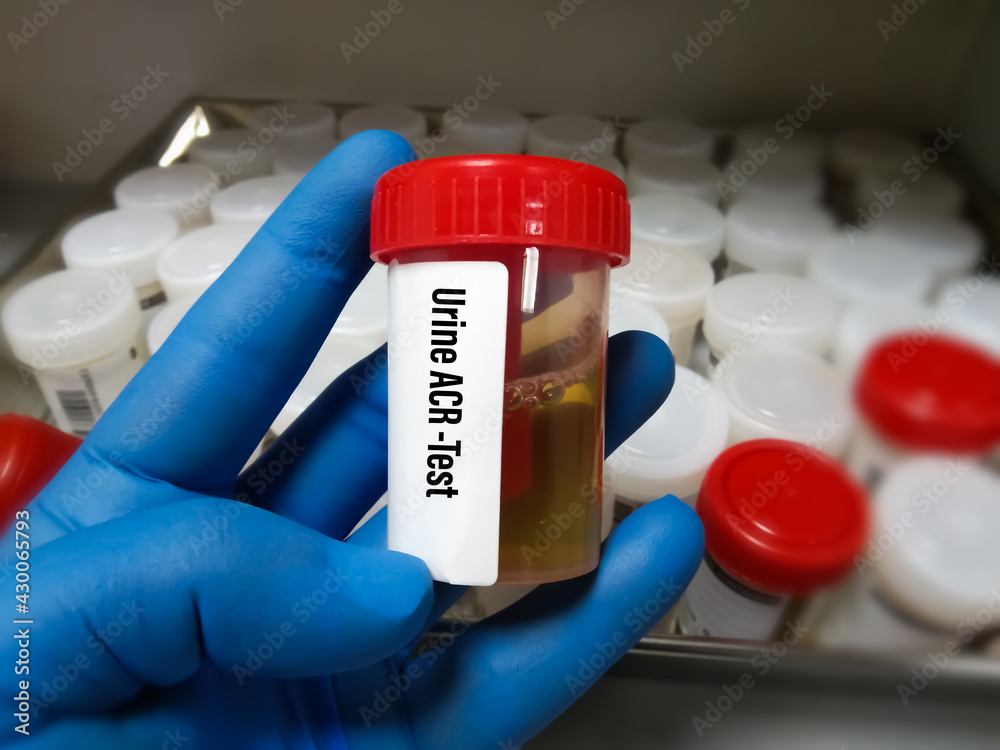 Urine Sample for Urine ACR (Albumin creatinine Ratio). Diagnosis of ...