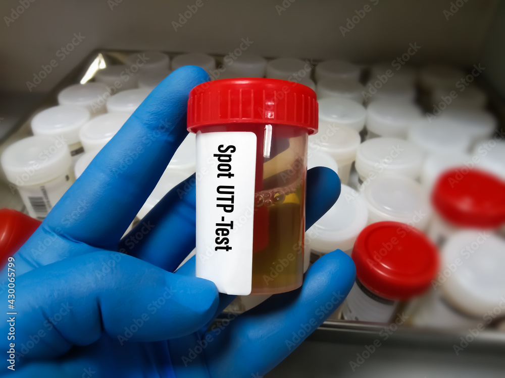 Sample for the measurement of the concentration of 24 hours urinary ...