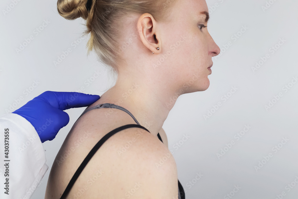 Kyphosis. The woman suffers from a curvature of the spine in the upper ...