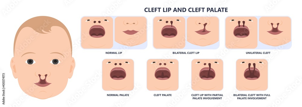 Cleft lip birth defect baby face nose Born gene drink bifid uvula roof ...