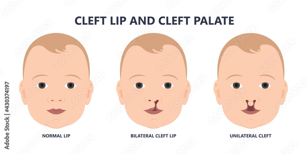 Cleft lip birth defect baby face nose Born gene drink bifid uvula roof ...