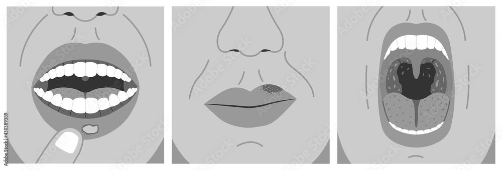 Canker sore, cold sore and sore throat. Black and white vector ...