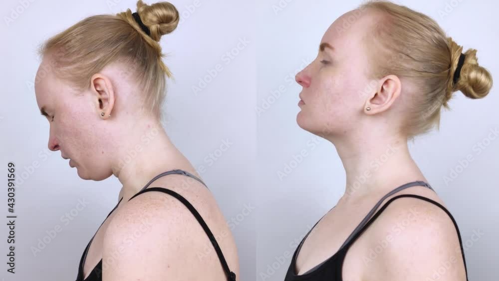 Vídeo do Stock: Before and after kyphosis. The woman suffers from a ...