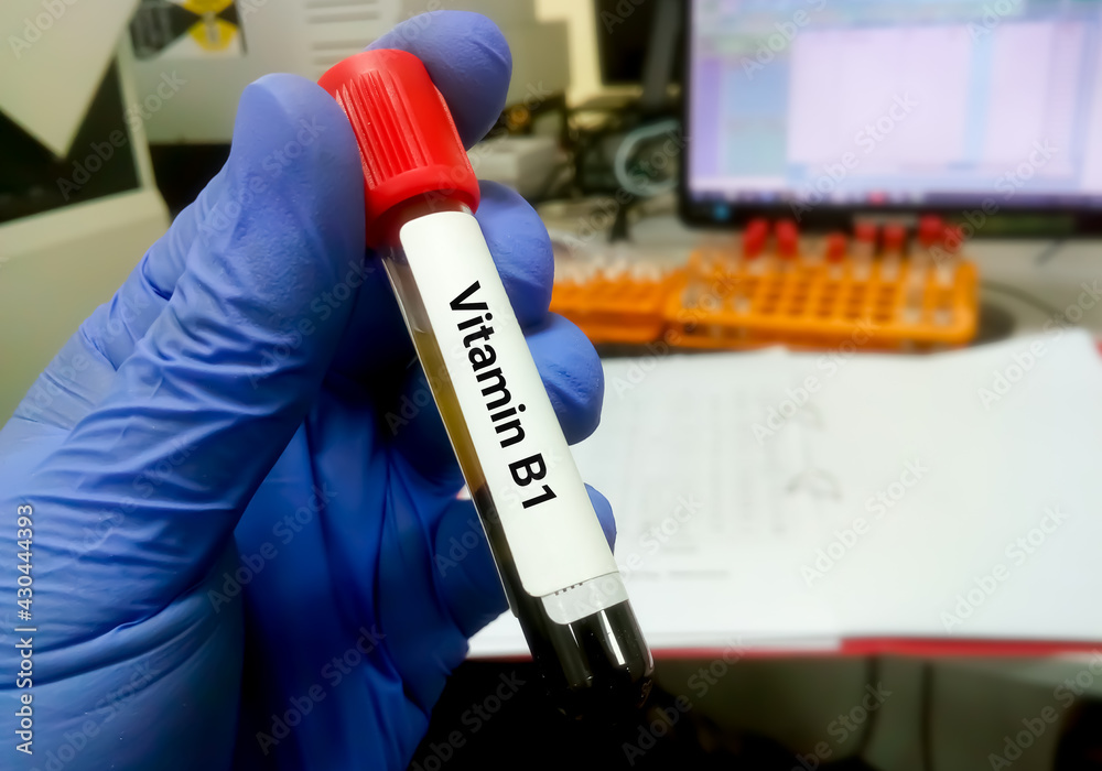 Blood sample for Vitamin B1 or thiamine test Stock Photo | Adobe Stock