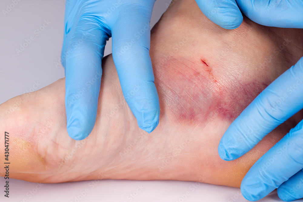 Doctor is examining an injured foot with bruise and scratch. Bruise on ...