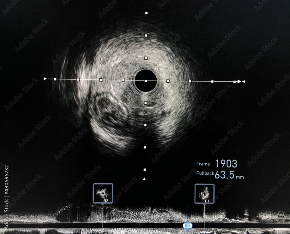 Intravascular Ultrasound Imaging Ivus Shown Guide Wire In A False