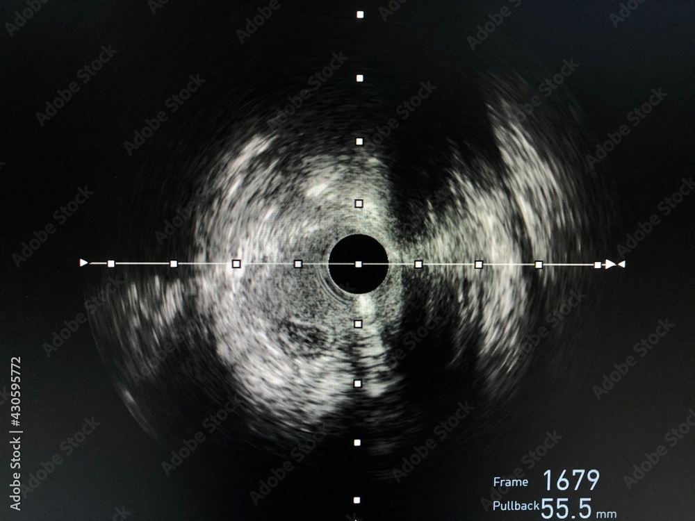 Intravascular ultrasound imaging (IVUS) shown guide wire in a false ...