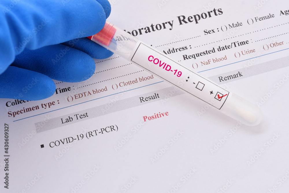 Nasopharyngeal swab positive with COVID-19 test by using RT-PCR method ...