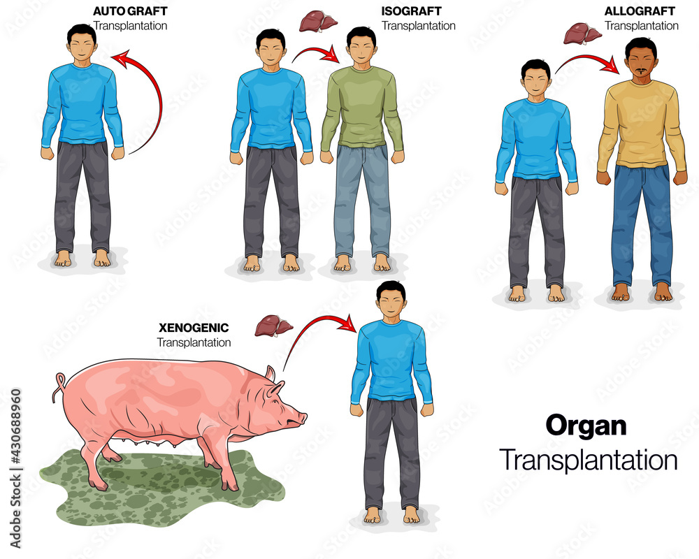 Illustration of Types of organ transplantation in Humans. Stock Vector | Adobe Stock