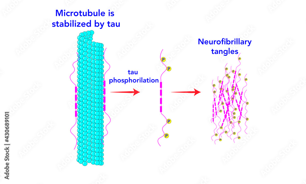 Neurofibrillary tangles [Tau proteins] microtubule Stock Vector | Adobe ...