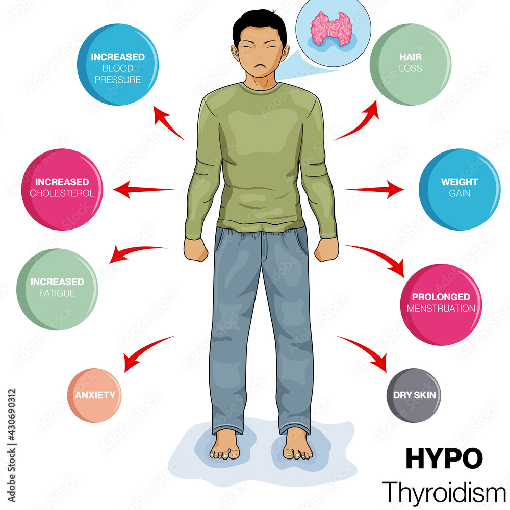 Illustration of Symptoms of Hypothyroidism disease in humans. Stock ...