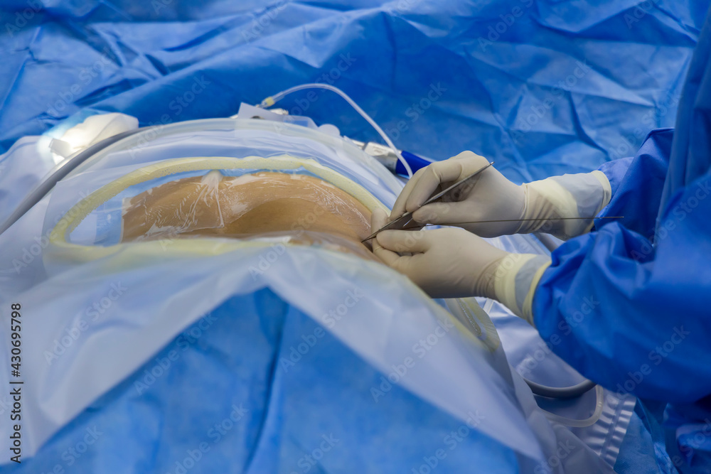 Surgeon in blue surgical gown uniform doing incision before insert ...