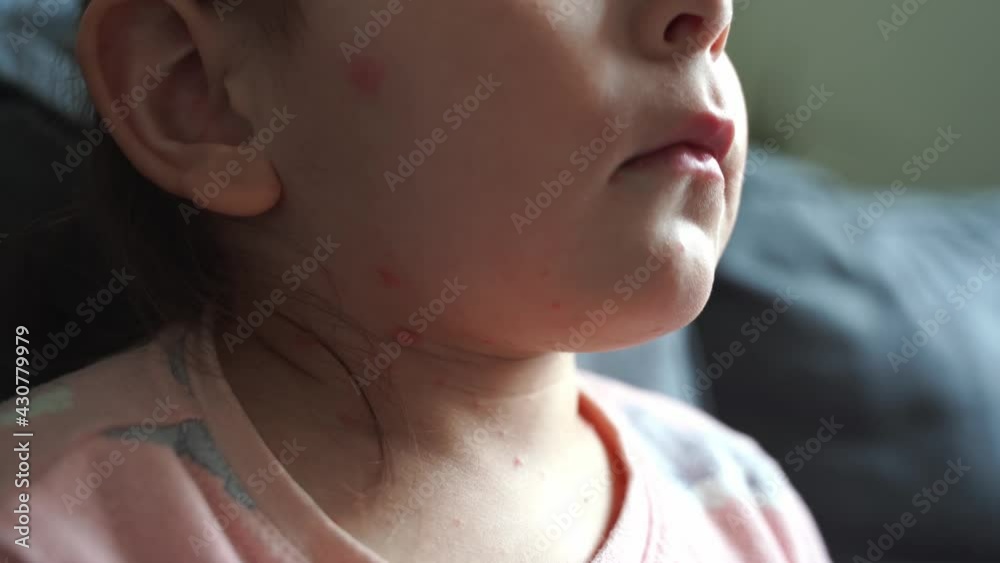 Toddler girl with chickenpox measles on the body. Varicella virus ...