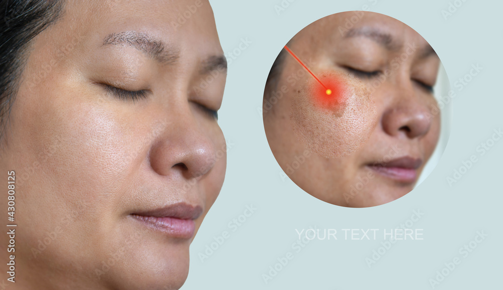 Foto de Retouch image with laser beam on imperfect skin problem ...