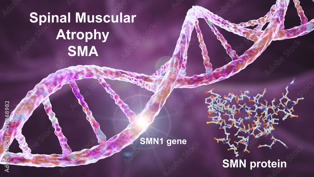 Spinal muscular atrophy, SMA, a genetic neuromuscular disorder with ...