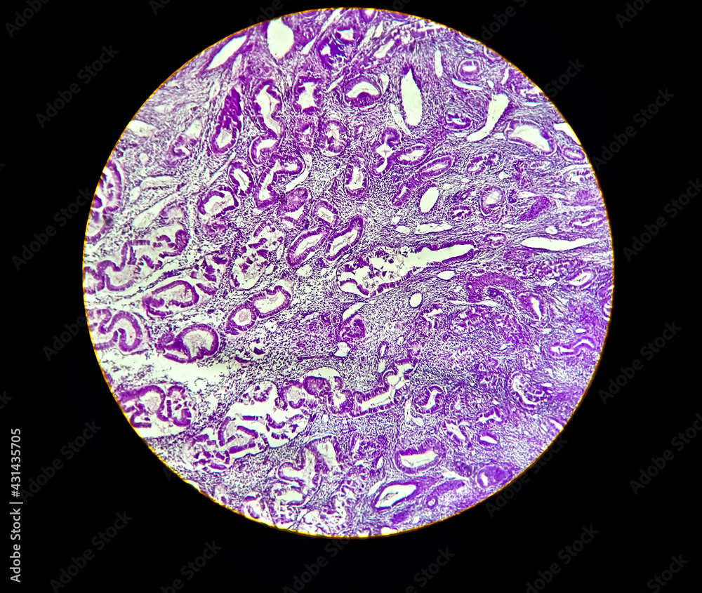 Microscopic view of Histology stained slide. closeup.carcinoma. Biopsy ...