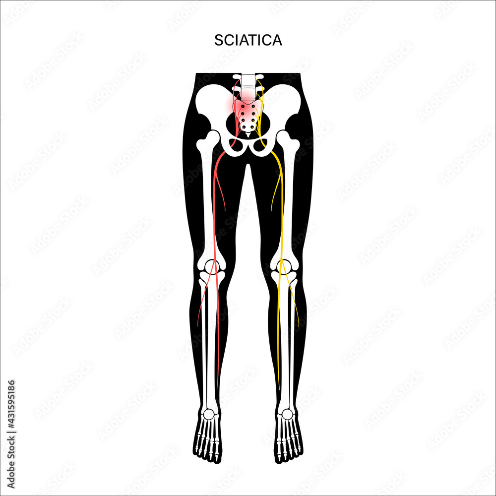 Muscular pelvis sciatica Stock Vector | Adobe Stock