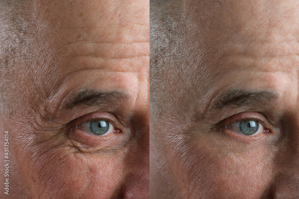 Old Wrinkled Forehead