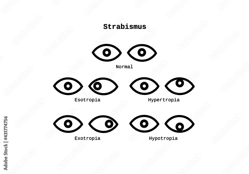 Simple vector diagram of the different types of strabismus Stock Vector ...