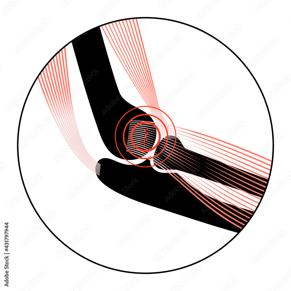 Lateral epicondylitis tennis elbow Stock Vector | Adobe Stock