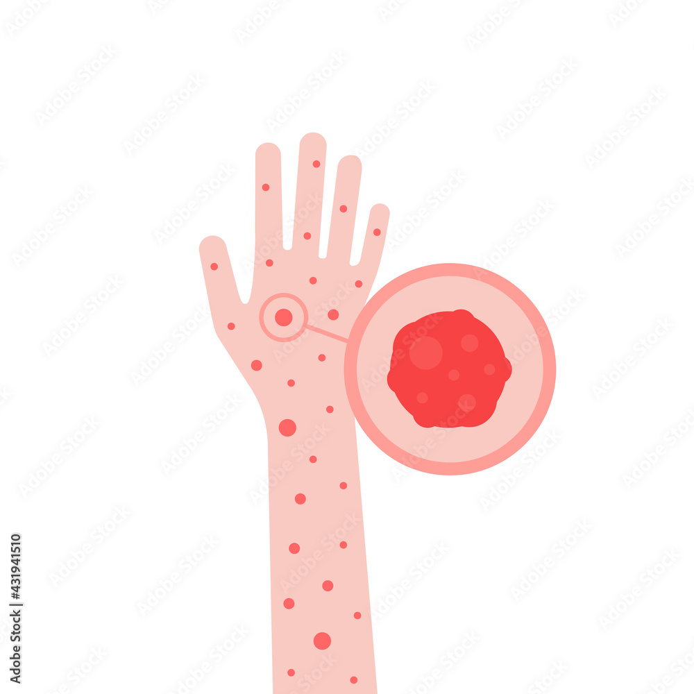 cartoon hand with psoriasis or eczema Stock Vector | Adobe Stock